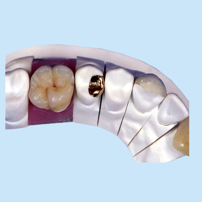 PFM Porcelain Dental Crown