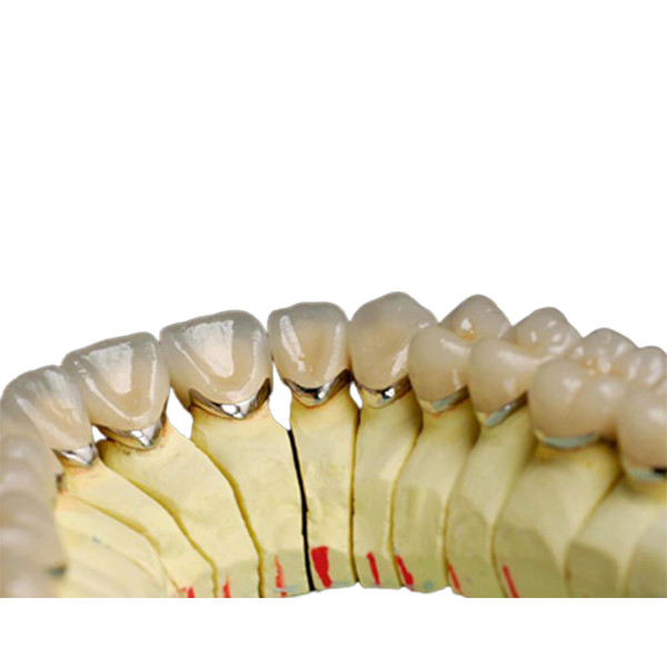 Dental Laboratory Titanium alloy Porcelain Dental Crown Natural Metal ...