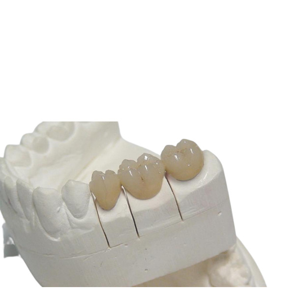 Temporary CAD / CAM PFM Dental Crown 3D Printing Design Denture ...