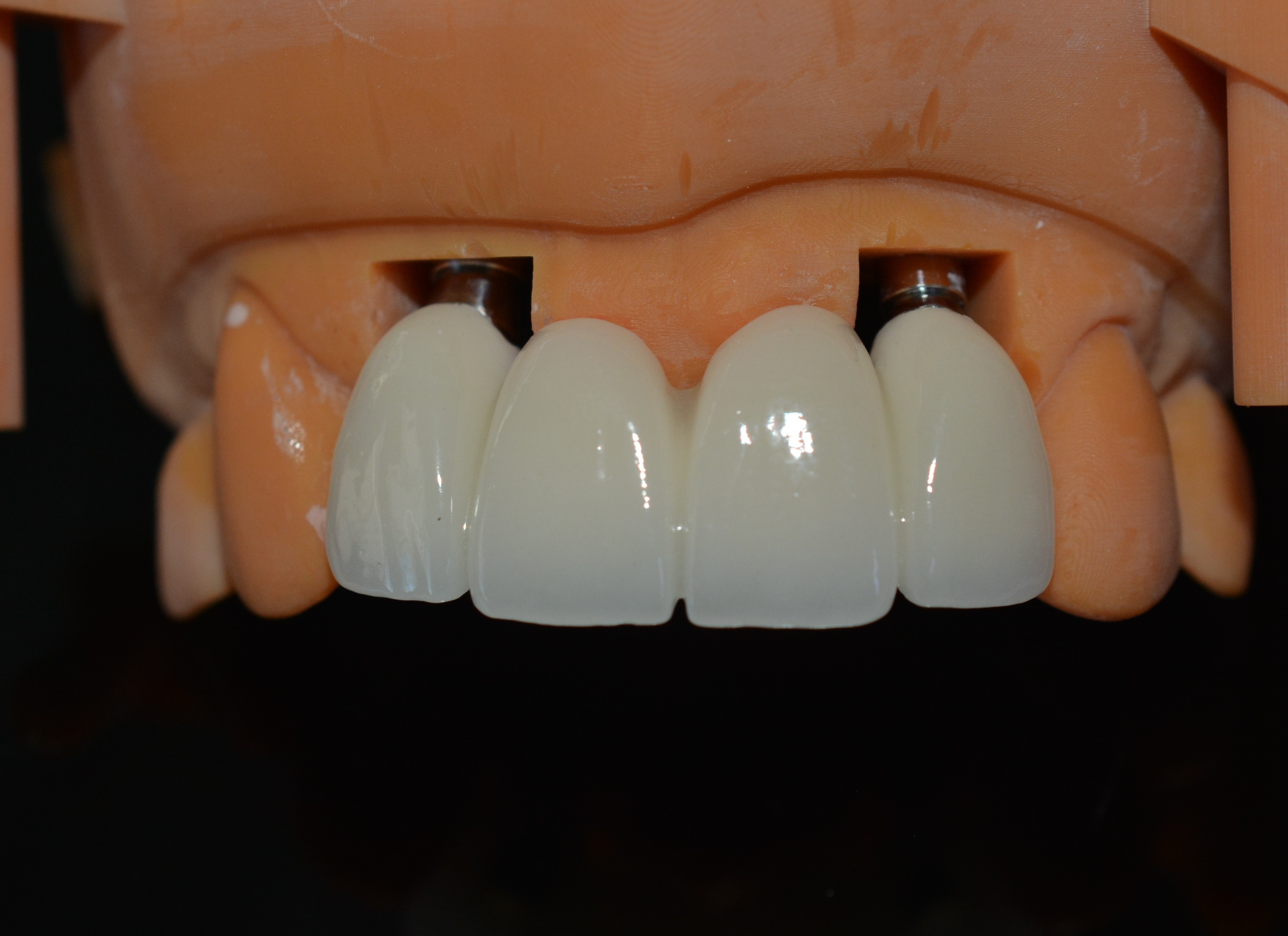 Precise CAD/CAM Design Zirconia Dental Crown for Fitment