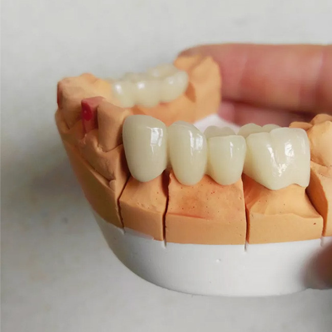 Smooth Surface Removable Partial Dentures PFM Dental Bridge High ...