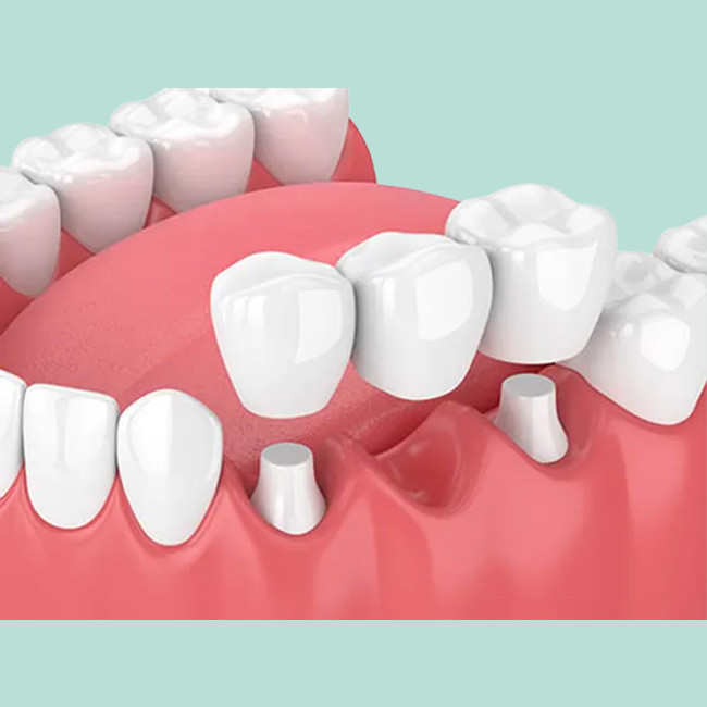 High Strength Dental Crown Bridge Realistic Appearance Good Stability ...